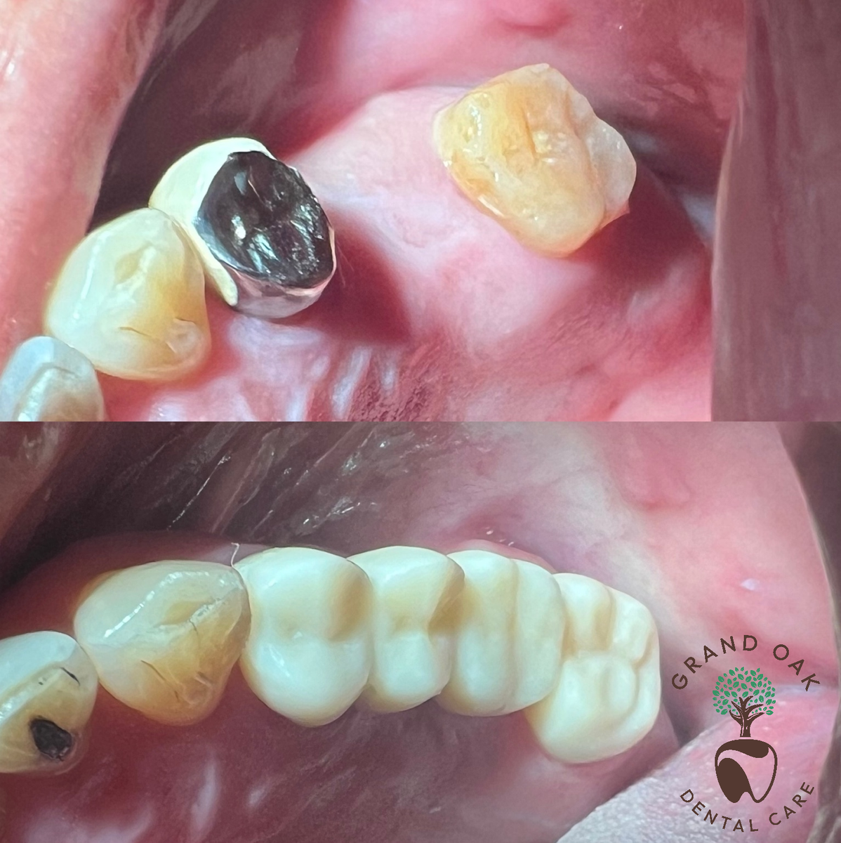 Grand Oak Dental Care - Dental Crowns & Bridges Before & After